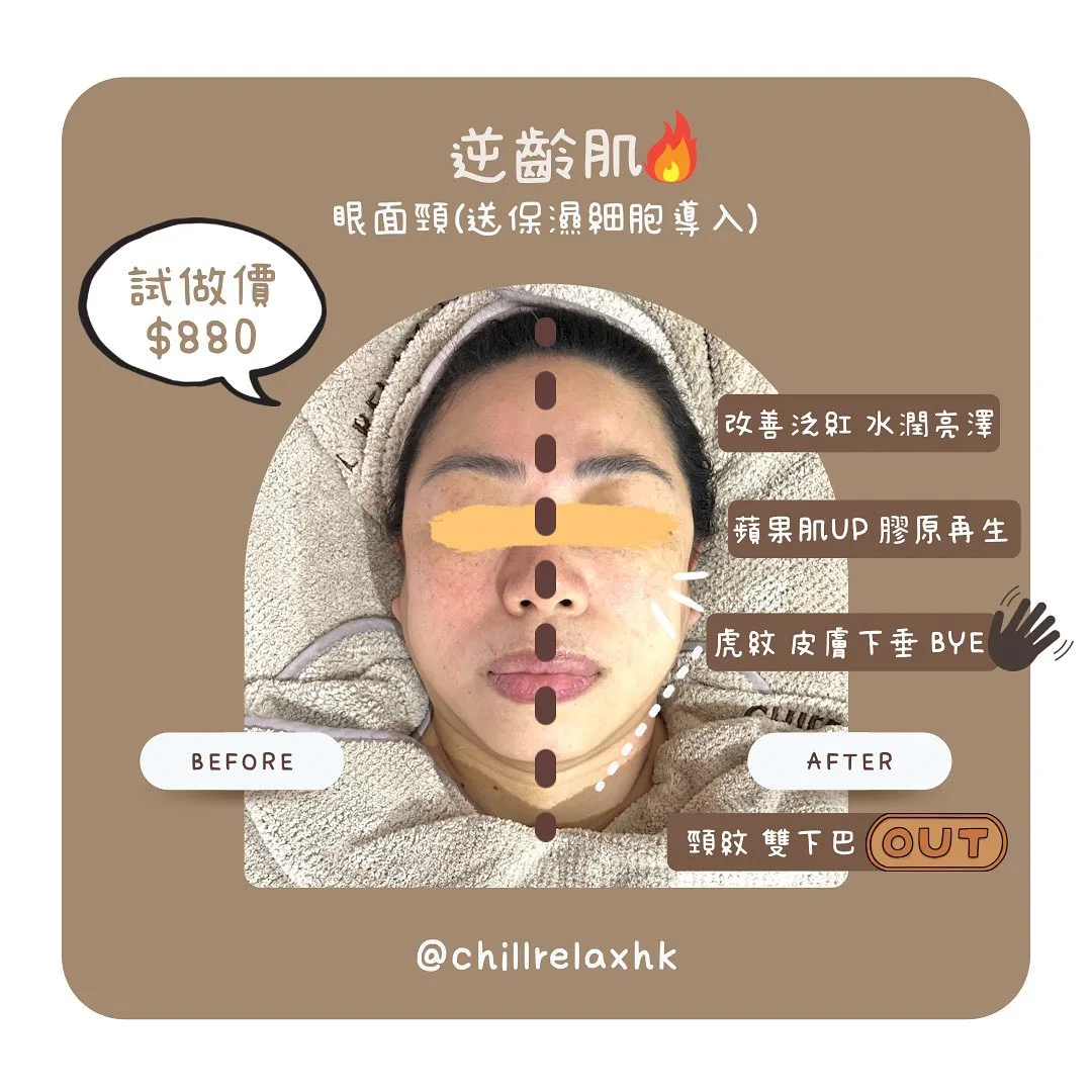 HIFU：療程常見問題解答 - Chillrelaxhk